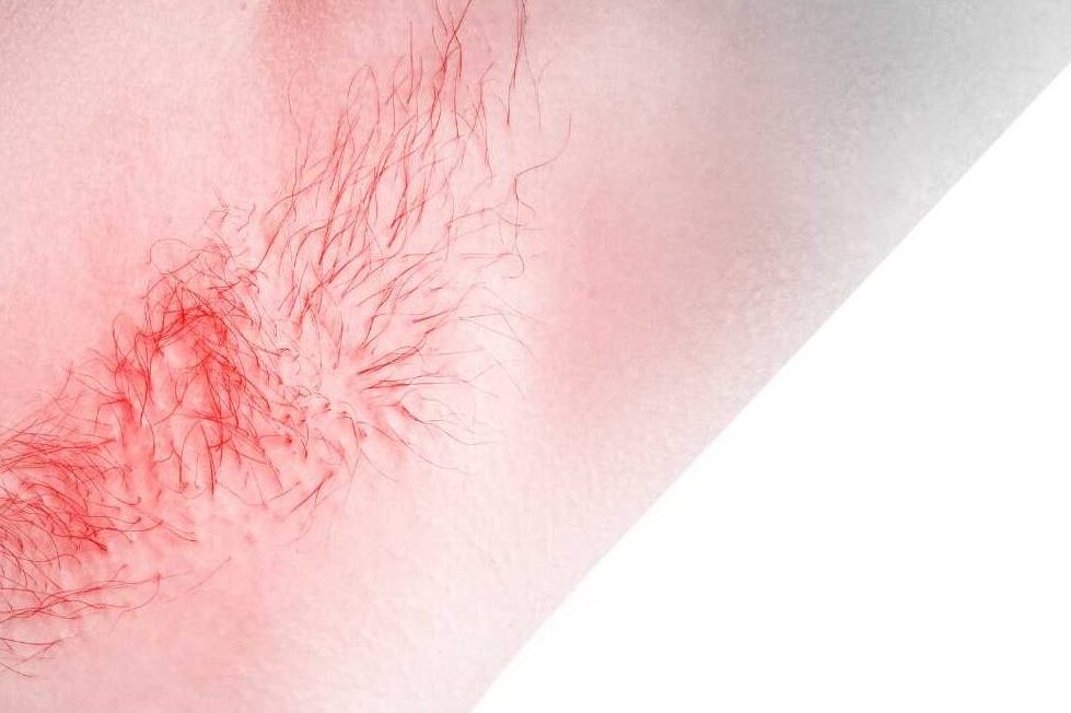 Les causes et traitements des boutons blancs qui grattent - Charonne ...